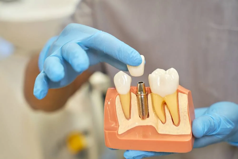 Dental Implants A Permanent Solution For Missing Teeth